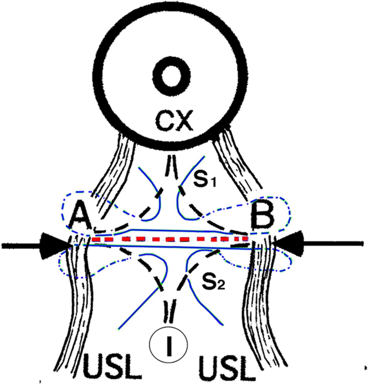 Minimally invasive Fothergill -Manchester operation with connective ...