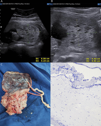 Twin pregnancy with complete hydatidiform mole and viable fetus: a case ...