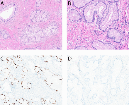 Human papillomavirus negative cervical cancers and precancerous lesions ...