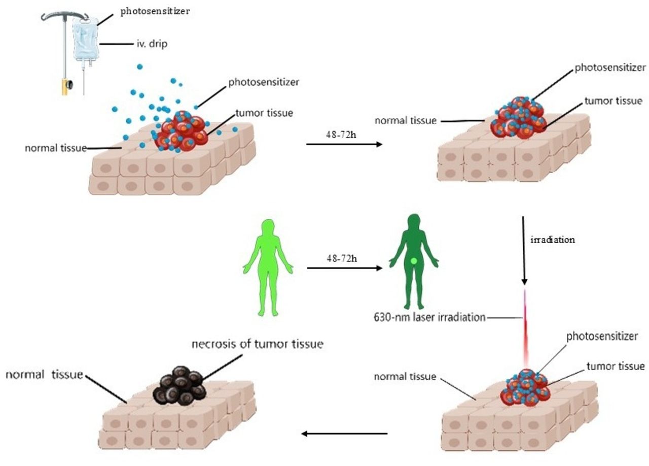 Chinese expert consensus on the hematoporphyrin derivative (HpD) photodynamic therapy in ...